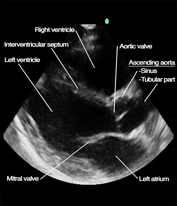 12 - The parasternal long-axis view - identifying structures - USabcd