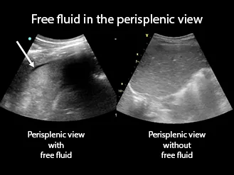 30 - Video showing free fluid in the perisplenic view - USabcd