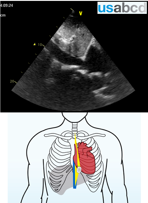 Cardiac ultrasound Archives - Page 13 of 41 - USabcd