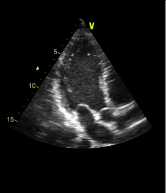 Cardiac ultrasound Archives - Page 11 of 41 - USabcd