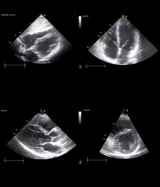Cardiac ultrasound Archives - USabcd