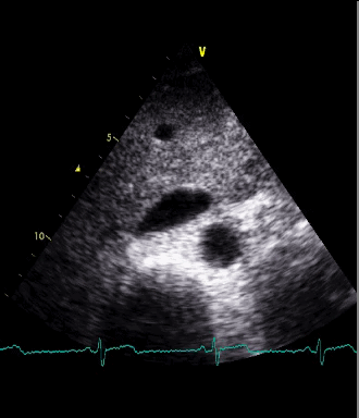 27 - Obtaining the longitudinal image of the IVC from the short axis ...